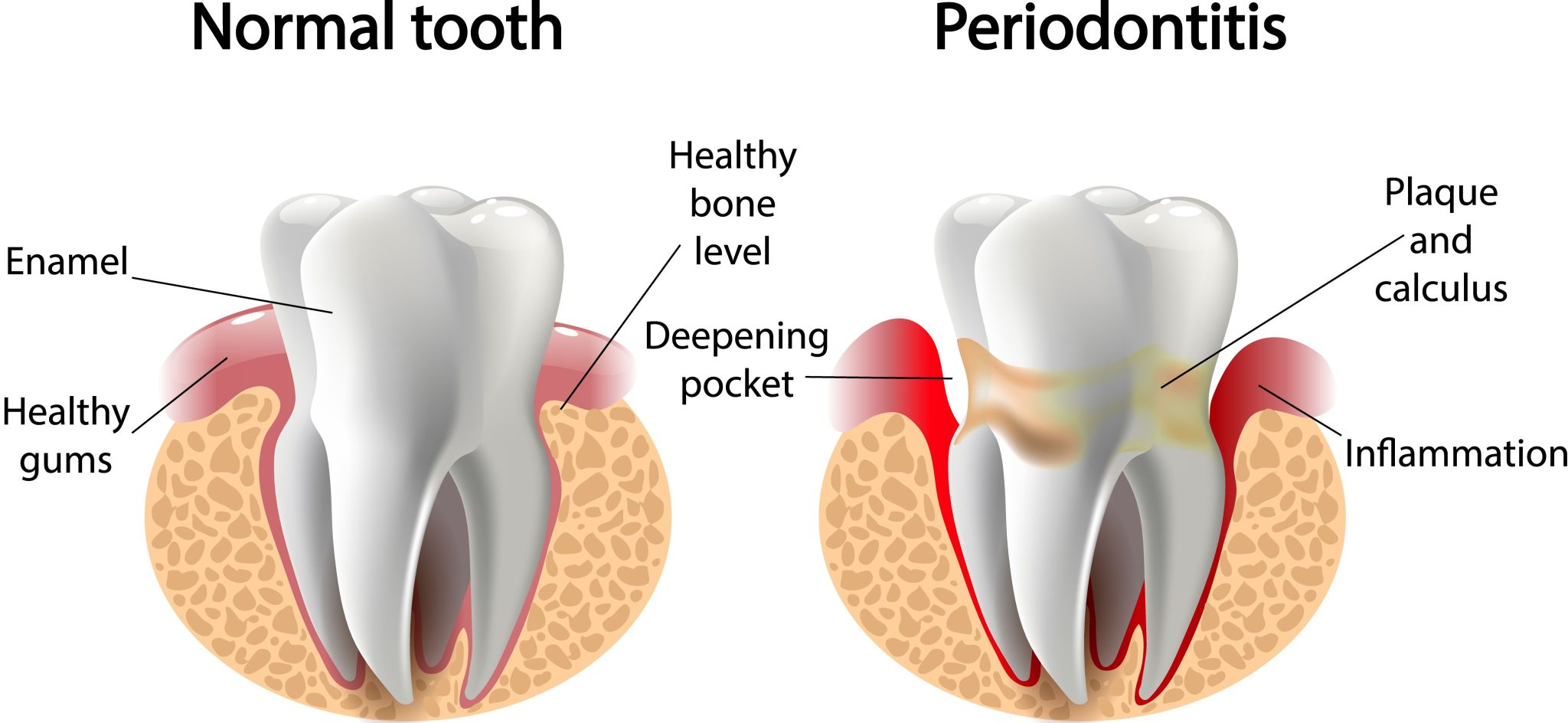 Understanding Periodontal Disease | Pearland, TX Dentists