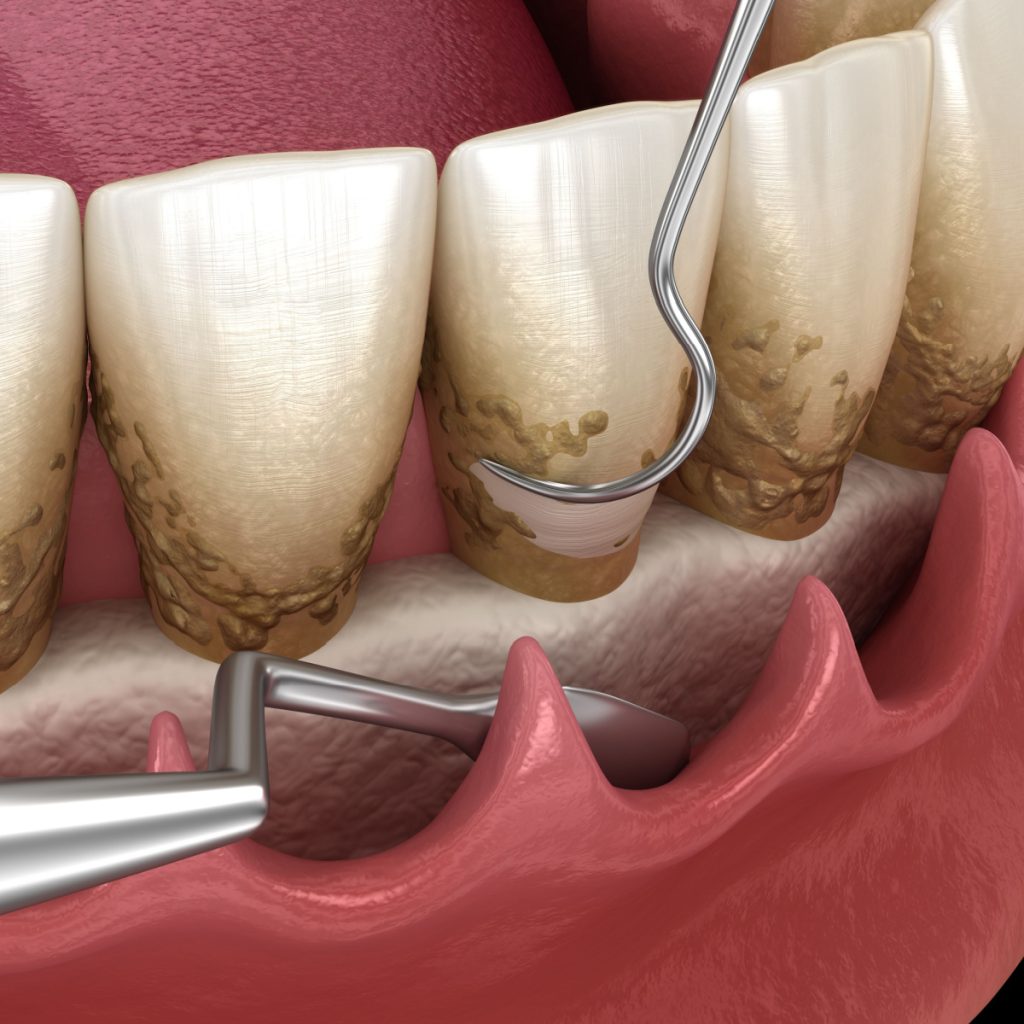 Root Planing and Scaling | Pearland, TX Dentists